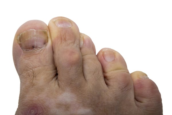 Toe Pain And Discolored toenails